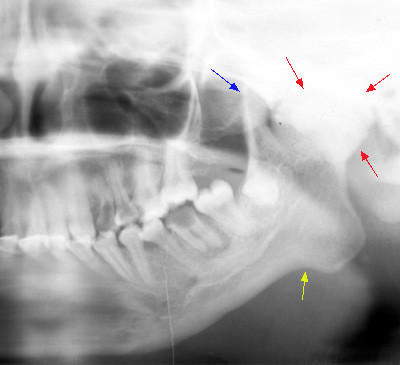 Caso N° 19: Anquilosis de la articulación temporomandibular – CDI Perú