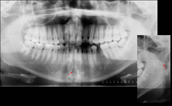 Caso N° 218: FRACTURA MANDIBULAR – CDI Perú