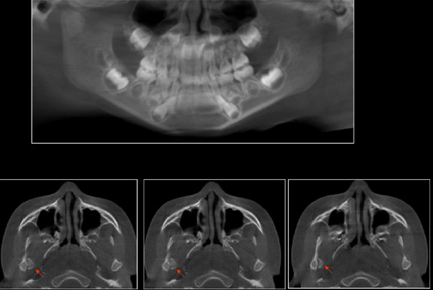 Caso N°290: FRACTURA DE CÓNDILO MANDIBULAR (Evaluación con tomografía ...