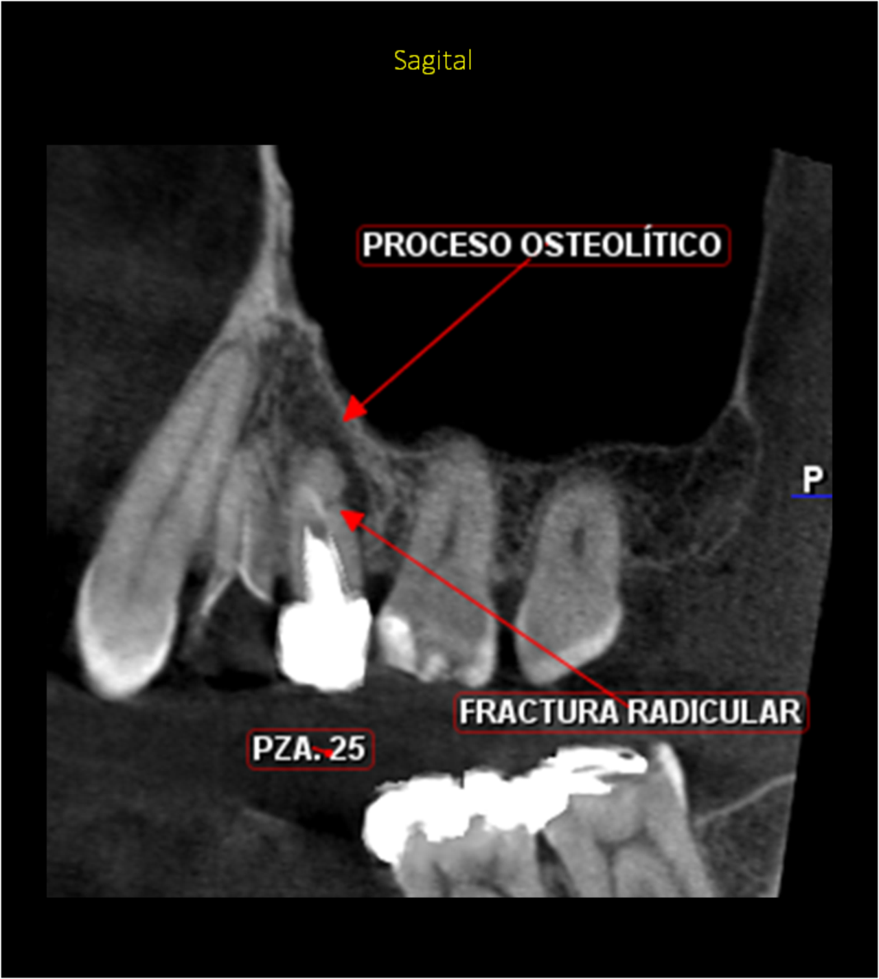 Caso N° 559: Fractura Radicular – CDI Perú