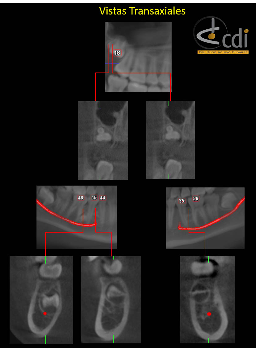 Caso N° 587: Múltiples piezas supernumerarias: Localización por medio ...