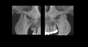 Caso Nº 360: LUXACIÓN DE ARTICULACIÓN TEMPOROMANDIBULAR – CDI Perú