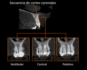 Caso Nº 393: PERFORACIÓN RADICULAR – CDI Perú