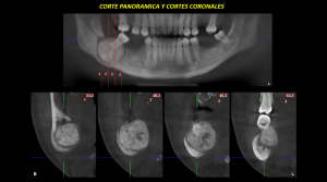 Caso N°655: Cementoblastoma – CDI Perú