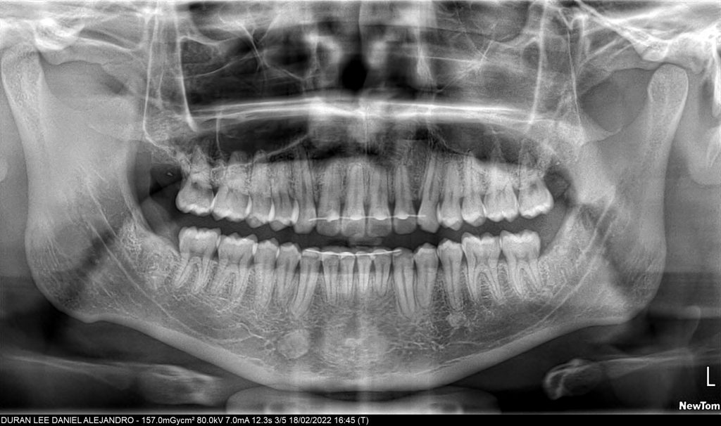 Caso N°667: Sinusitis Odontogénica – CDI Perú