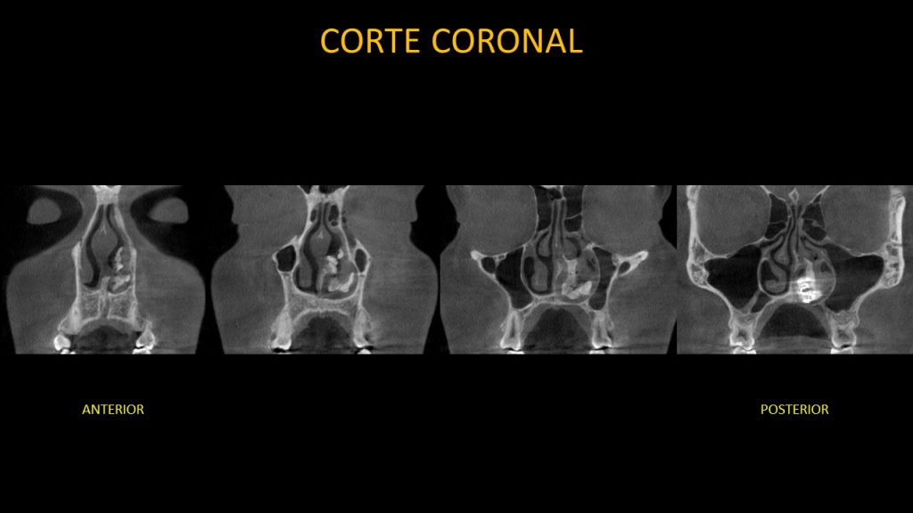 Caso N°669: Probable Rinolito – CDI Perú