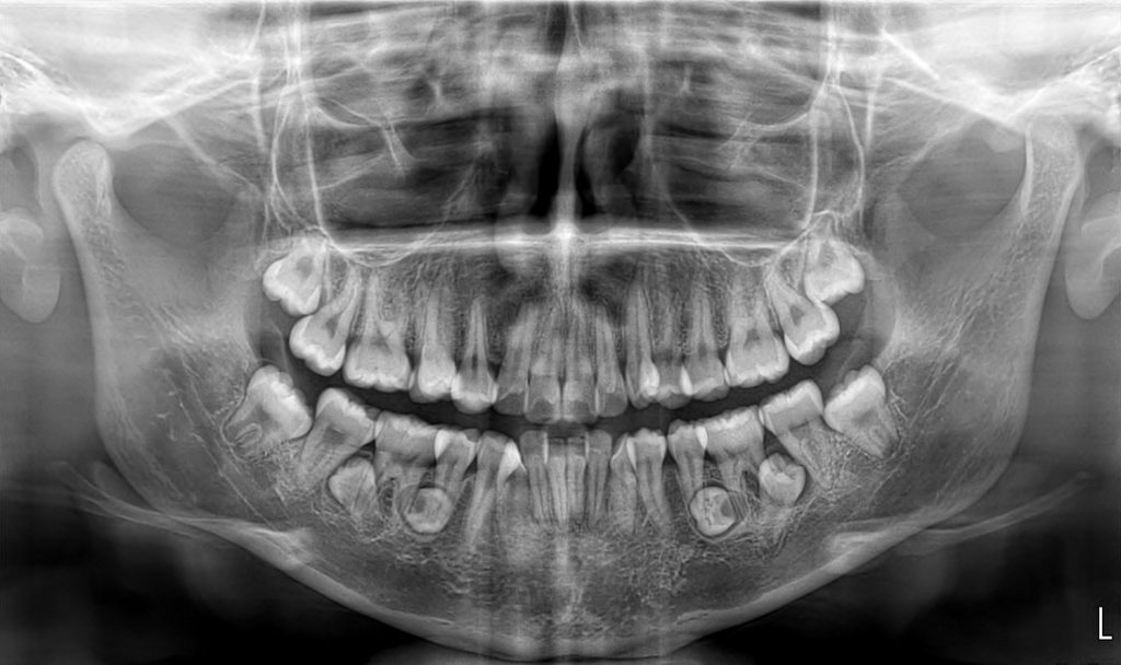 Caso N°675: Hiperdoncia (Dientes Supernumerarios) – CDI Perú