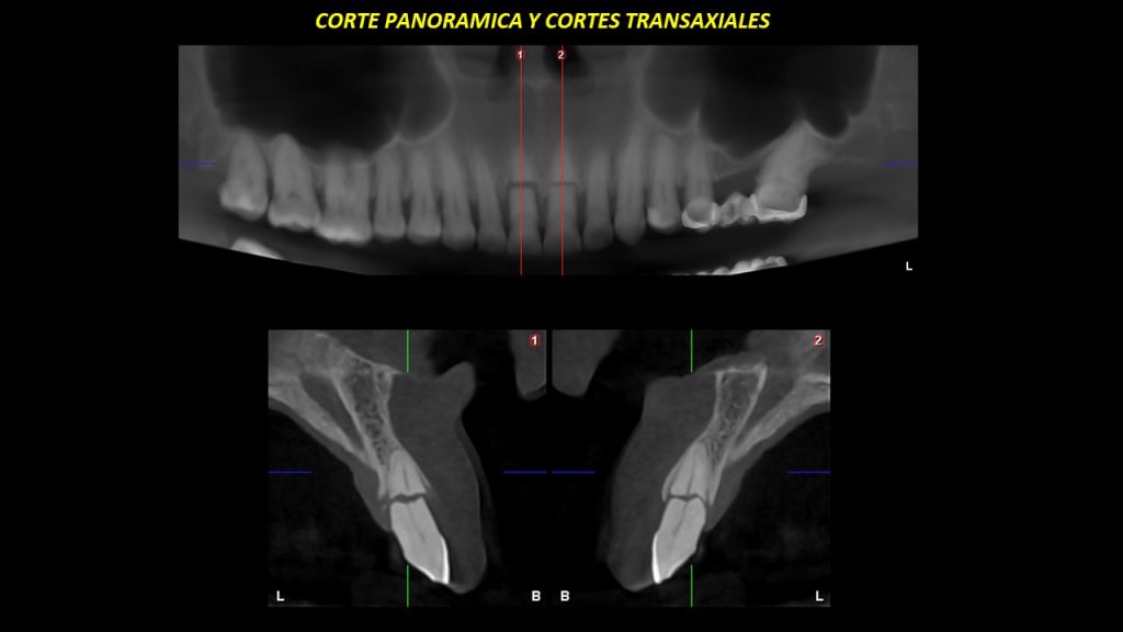 Caso N°686: FRACTURA RADICULAR – CDI Perú