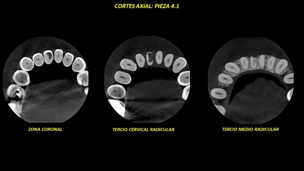 Caso N°688: REABSORCIÓN CERVICAL INVASIVA – CDI Perú