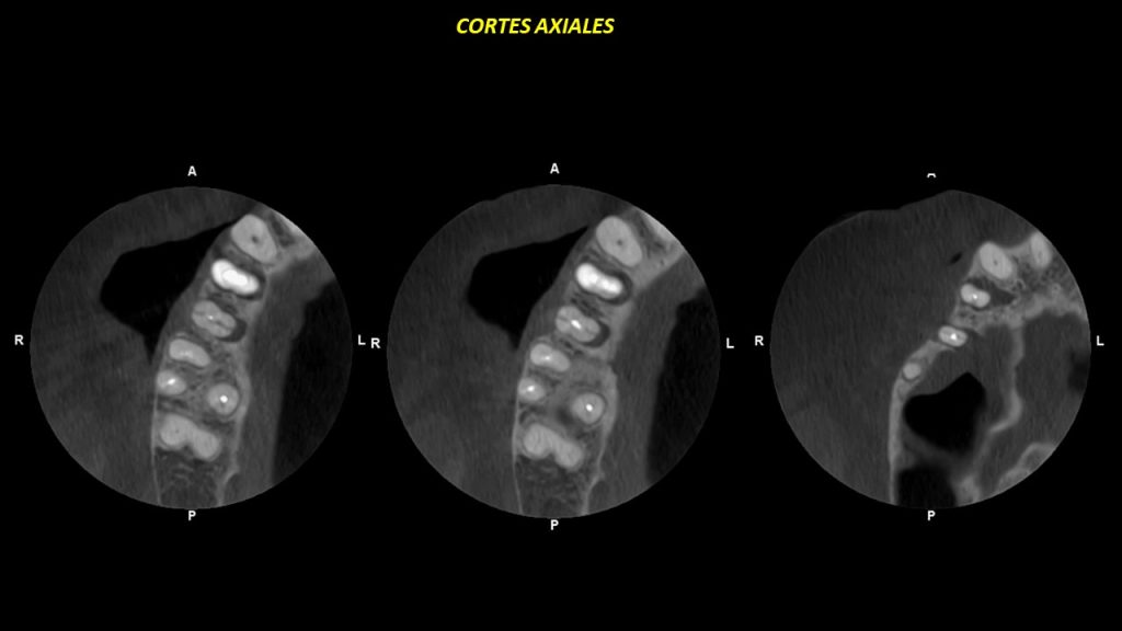 Caso N°698: FRACTURA RADICULAR VERTICAL – CDI Perú