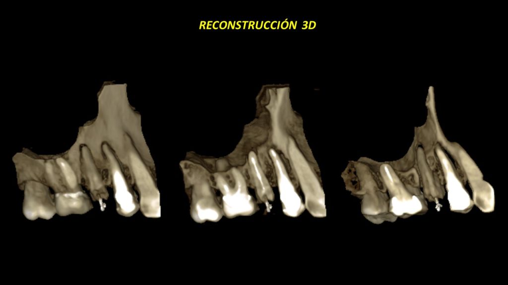 Caso N°698: FRACTURA RADICULAR VERTICAL – CDI Perú